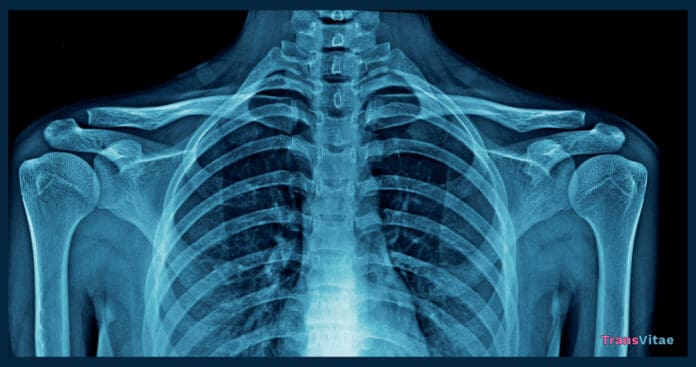 Study Shows HRT and Puberty Blockers Reshape Trans Skeletons